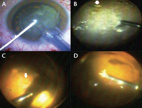 Versatile Vitrectomy Retina Today