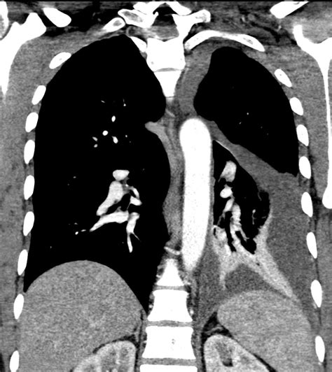 Faces Of Atelectasis Compressive The Common Vein Faces Of Atelectasis Compressive The Common Vein