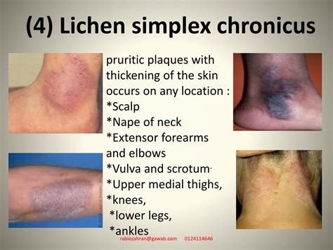 Ppt Pruritus Manifestation Of Systemic Disease Powerpoint Presentation Id 1073814