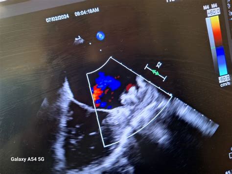 Sami Almuhammad On Linkedin Watchman Device Inserted In Laa Tee