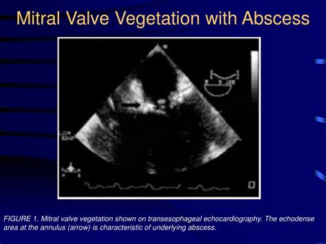 Ppt Infective Endocarditis Powerpoint Presentation Id3363817
