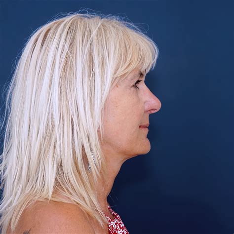 Operace Víček Klinika Esthé Praha