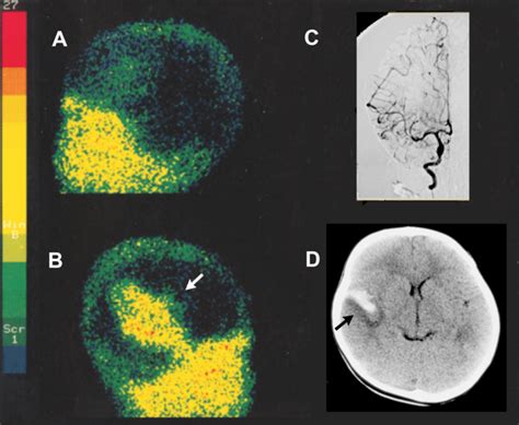 Herpes Simplex Encephalitis Involving The Right Temporal Lobe A And B Download Scientific