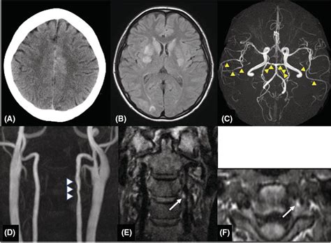 Neuroradiological Findings At Onset A Plain Ct Scan Revealed Hyper Download Scientific