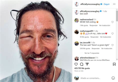 Matthew Mcconaughey Queda Desfigurado Tras Sufrir Picadura De Abeja En El Rostro