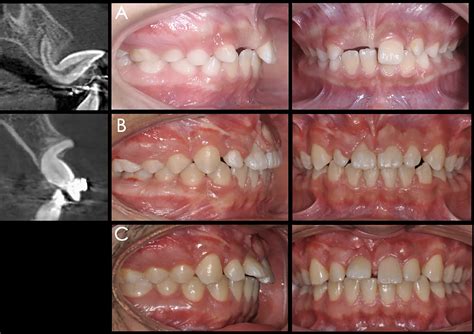 Orthodontic Management Of Ectopic And Impacted Teeth Seminars In