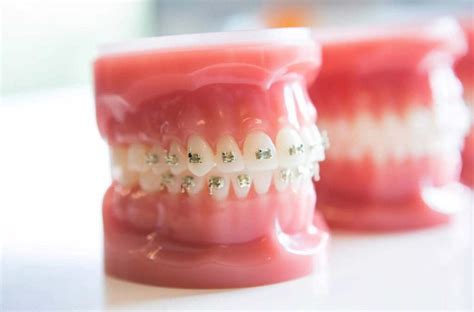 Mild Gingivitis With Braces