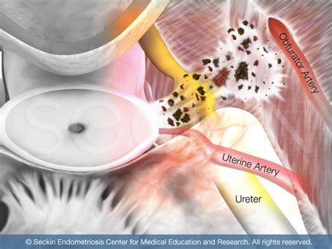 What Is Pelciv Adhesions And How They Are Treated Dr Seckin