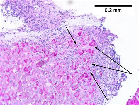 Hepatitis B Liver Histology