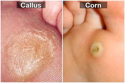 Common Foot Conditions Explained Corns And Callus Footpoint Podiatry