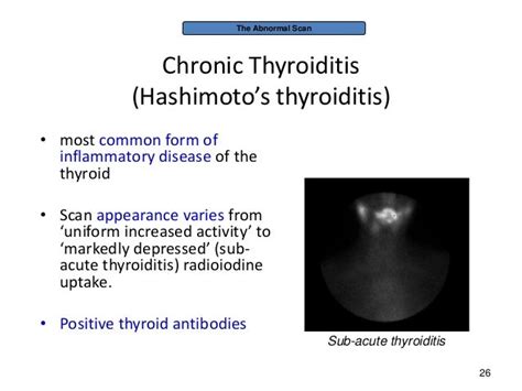 Thyroid Pathophysiology Scintigraphy[1]