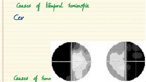 Ocular Signs Bitemporal Hemianopia And Homonymous Hemianopia Youtube