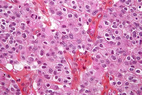 40 Facts About Oligodendroglioma