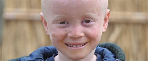 国际白化病宣传日 6月13日