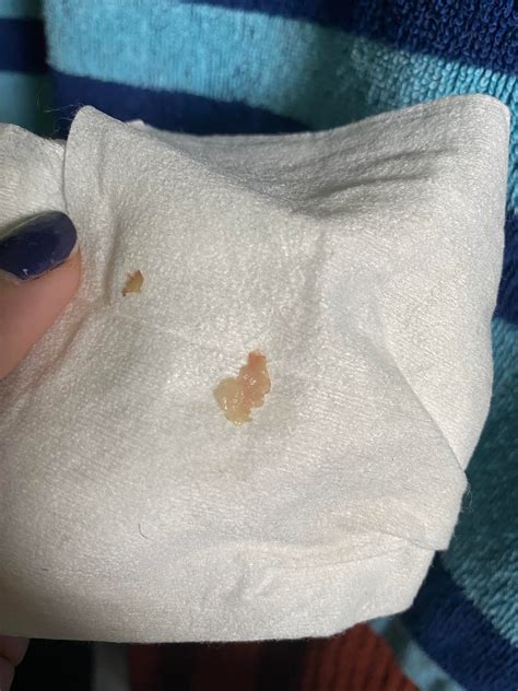 Biggest Tonsil Stone Ive Had Also Came Out With A Tiny One But It