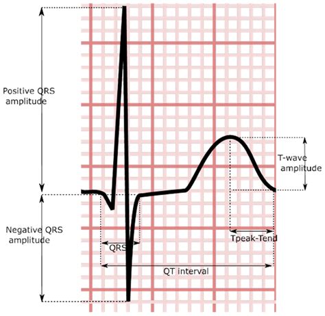 Atrial Fibrillation Ecg Criteria
