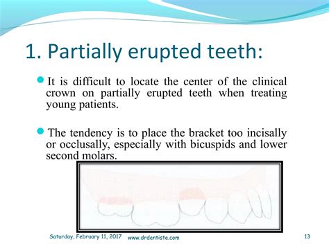 Mbt Bracket Placement Ppt