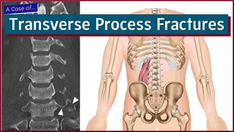 Transverse Process Fractures Meded Cases