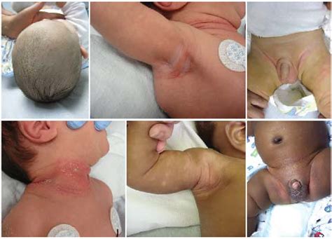 Infantile Seborrheic Dermatitis