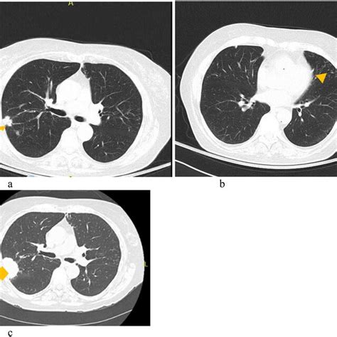 A Demonstrates A Spiculated Subpleural Nodule In The Right Upper Lobe