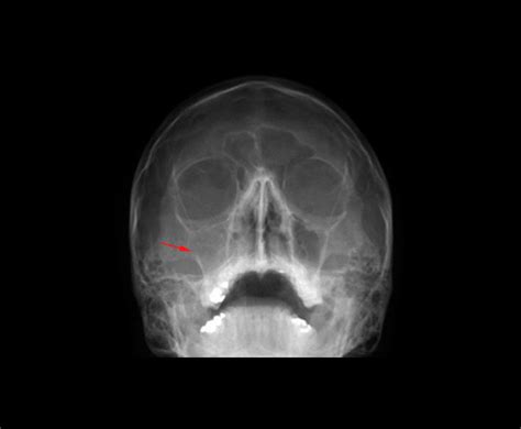 Caso Nº 267 Sinusitis Maxilar Cdi Perú
