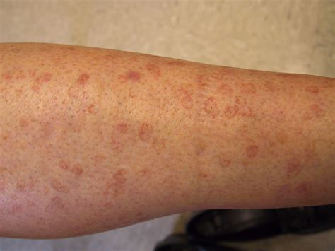 What Are Those Brown Spots On My Legs Htllb