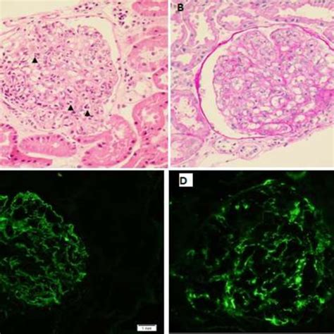 A A Glomerulus Depicting Prominent Endocapillary Hypercellularity With