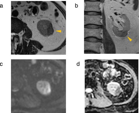 Follow Up Mri Study Of The Left Renal Mass After 6 Months A T2wi