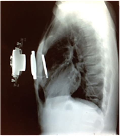 Lateral Chest Radiograph Of A Patient With Pectus Excavatum Implanted Download Scientific