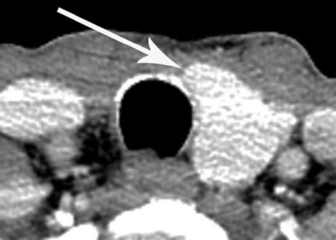 A 65 Year Old Man With Right Hemithyroidectomy For Papillary Thyroid