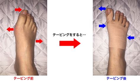 「間違ったテーピングは外反母趾を悪化させる」正しいテーピングの方法をご紹介。 京都 北区 上京区 肩こり 腰痛 整体 外反母趾 野球肩