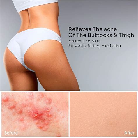 Bellamiluxx Butt Acne Clearing Lotion Natural Plant Extracts For Acne