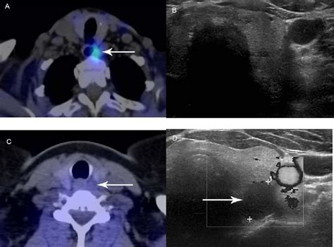 Figure 3 From Spect Ct Guided Ultrasound For Parathyroid Adenoma