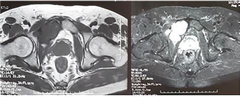 Figure 2 From Enneking Type Iii Resection Of Pubic Chondrosarcoma A Case Report Semantic Scholar