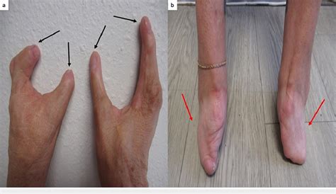 Embryopathy Caused By Thalidomide Affecting The Hands And Feet