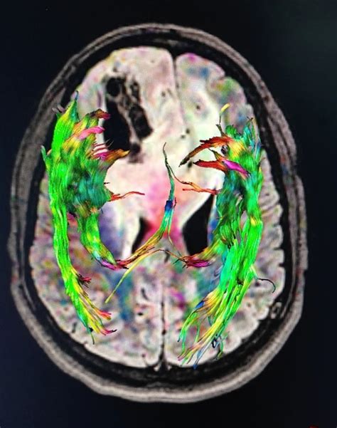 Diffusion Tensor Imaging Dti Tractography From An Mri Scan Of The