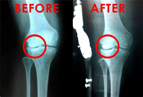 Unloader Knee Brace In The Treatment Of Osteoarthritis Integrative