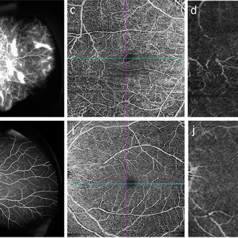 Pdf Diagnosis And Clinical Course Of Ocular Ischemic Syndrome With