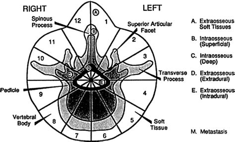 Figure1weinstein Boriani Biagini Wbb Classification 1997 This