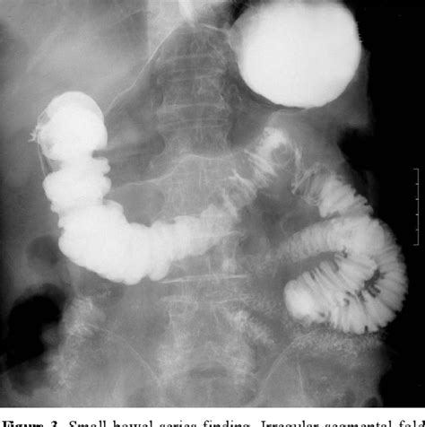 Figure 1 From A Case Of Ischemic Duodenal And Jejunal Enteritis In A
