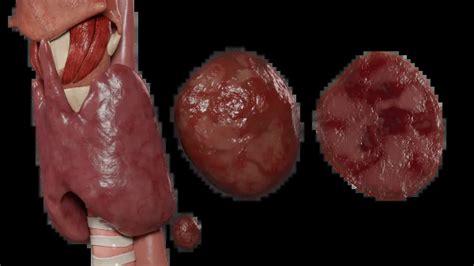 3d Model Of Primary Hyperparathyroidism Parathyroid Adenoma