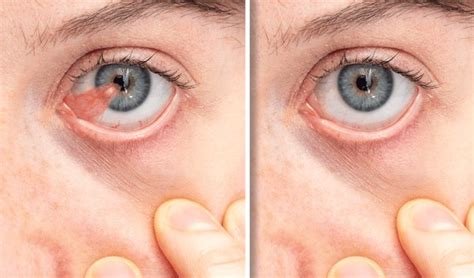17 En La Categoría Cirugia De Ojo Quitando Cornea De Fotos E Imágenes
