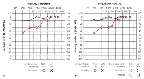Audiometry Screening And Interpretation Aafp En 2024