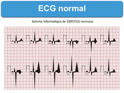 Ecg Normal E Cardiogram