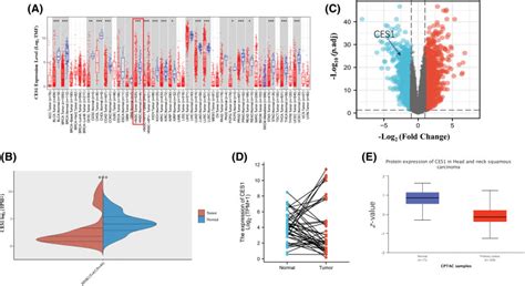 Ces1 Is Associated With Cisplatin Resistance And Poor Prognosis Of Head