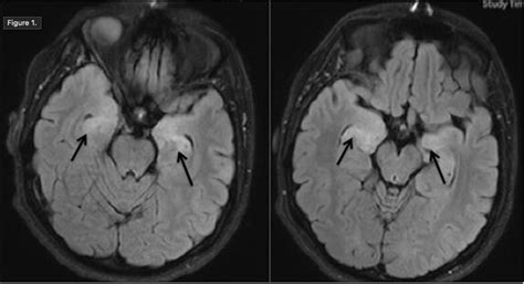 Epileptic Disorders On Linkedin Orhan And Tezer Present Video Eeg Of A 25 Yo F W Anti Voltage Gated…