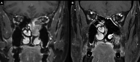 Free Mucosal Graft Reconstruction Used To Reconstruct A Unilateral