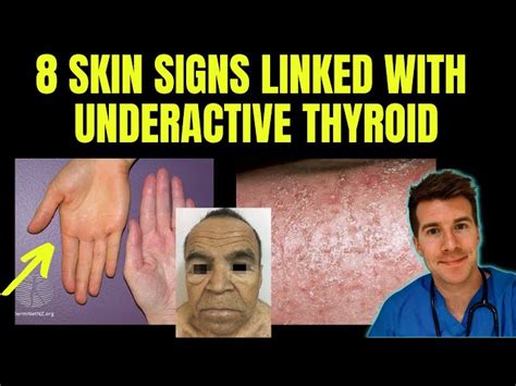 Hypothyroidism Itchy Skin Managing Skin Hair And Nail Issues In