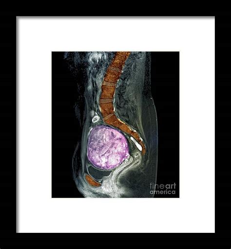 Uterine Fibroids Mri Scan Photograph By Zephyr 20 Week Scan Capturing