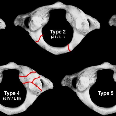 Gehweiler Classification Of Atlas Fractures 4 Type 1 Fractures Of
